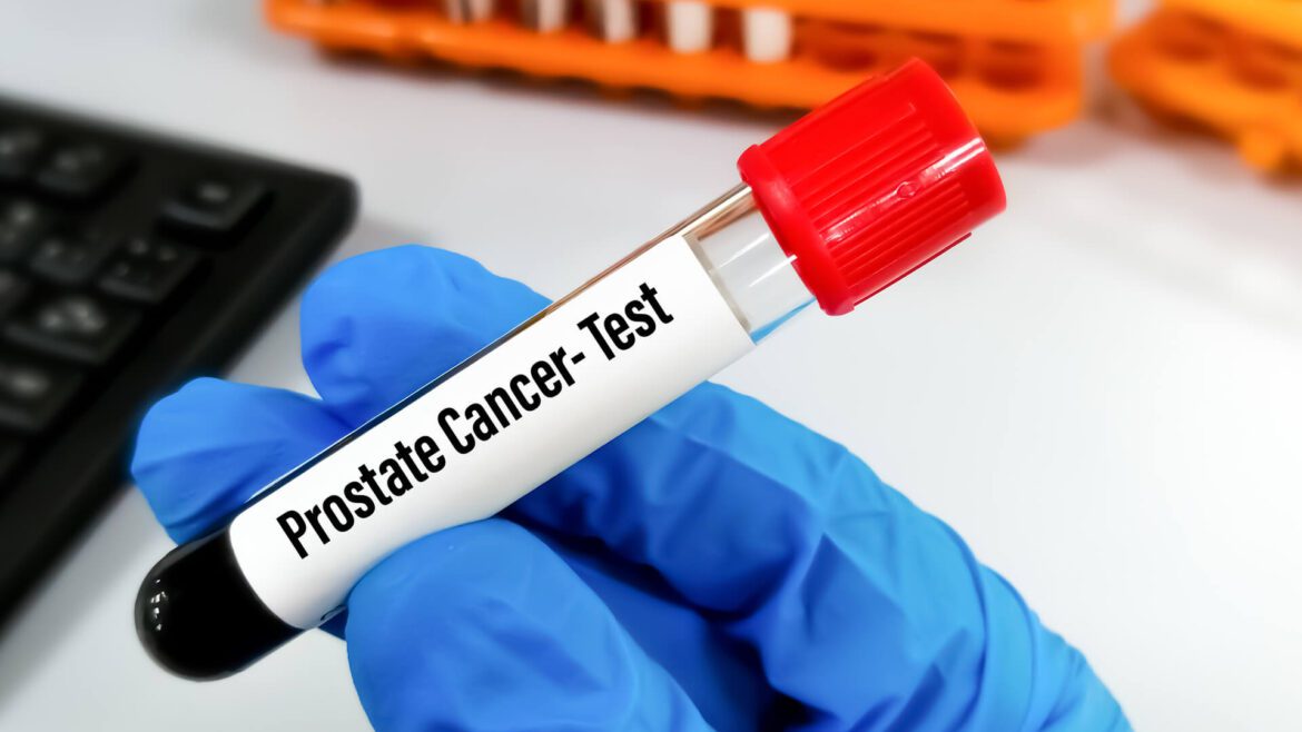 Common Types of Urological Cancers: Symptoms, Causes, and Treatment