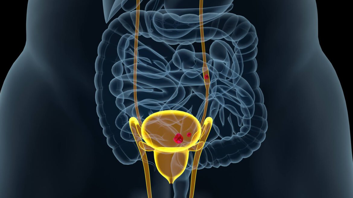 Optical Internal Urethrotomy (OIU) in 2023