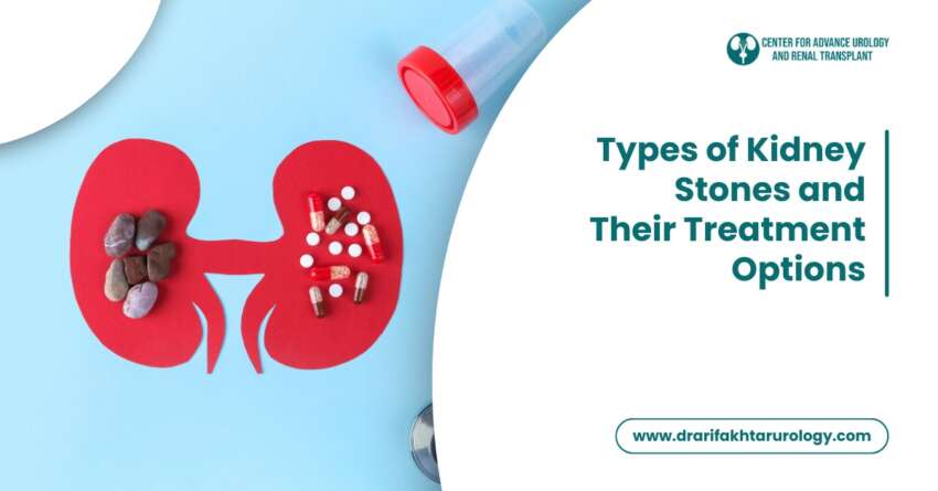 Types of Kidney Stones and Their Treatment Options | Urologist Guide